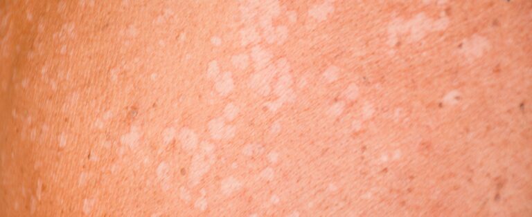 Dermatomicosi: Cos'è e Come si Cura | Normon